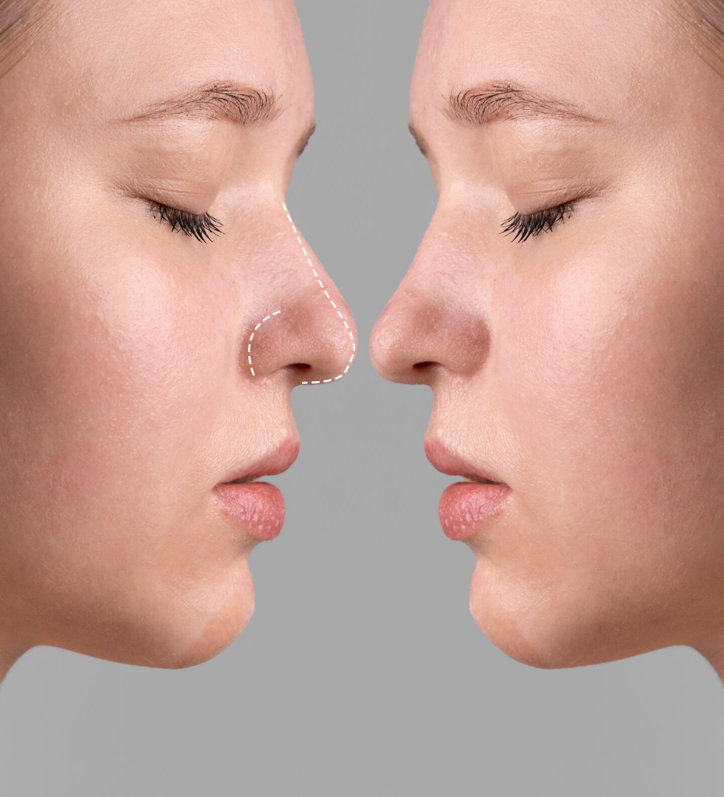 Rhinoplasty Recovery Timeline & Tips - The Avoca Clinic